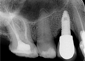 Espaço biológico peri-implantar - Plataforma VMCom