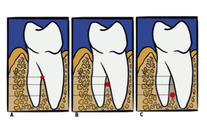 Sondagem da região de furca - Plataforma VMCom